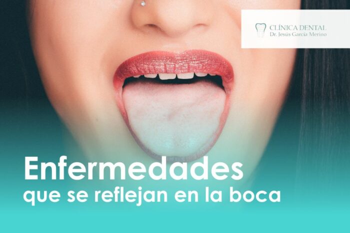 Sabes qué enfermedades se reflejan en la boca - Clínica Dental Jaén
