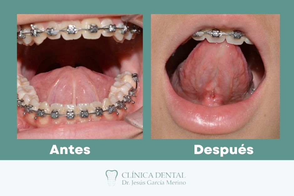 Frenillo bucal: ¿cuándo puede ser un problema? - Clínica Dental Jaén
