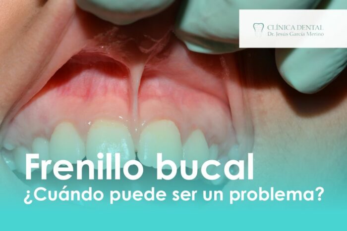 Frenillo bucal: ¿cuándo puede ser un problema? - Clínica Dental Jaén