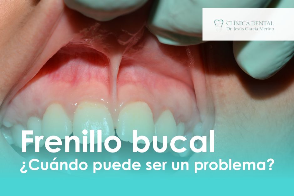 Frenillo bucal: ¿cuándo puede ser un problema? - Clínica Dental Jaén