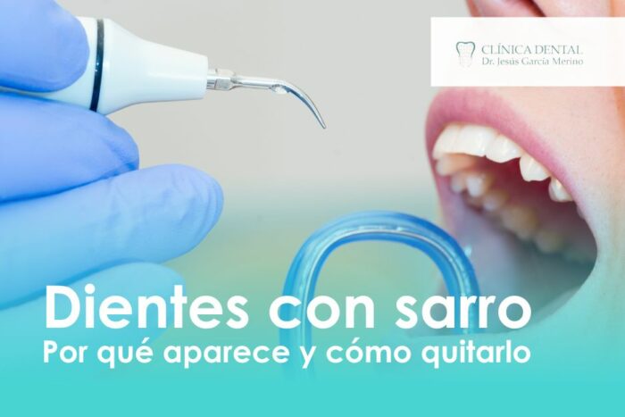 Dientes con sarro: ¿por qué aparece y cómo quitarlo? - Clínica Dental Jaén