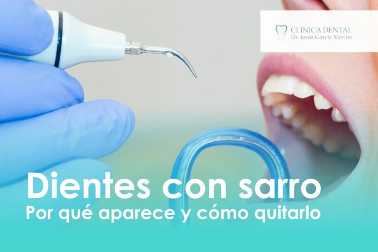 Dientes con sarro: ¿por qué aparece y cómo quitarlo? - Clínica Dental Jaén