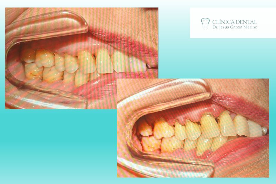 Dientes con sarro: ¿por qué aparece y cómo quitarlo? - Clínica Dental Jaén